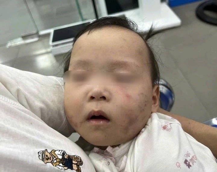 Bé gái bị bầm tím mặt sau khoảng 7 tiếng ở nhà trẻ tư thục: Tình trạng ...